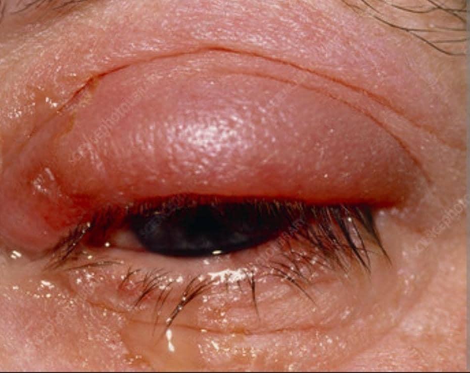 Pink eye cases keep rising as over 13,400 have been recorded – Maravi ...